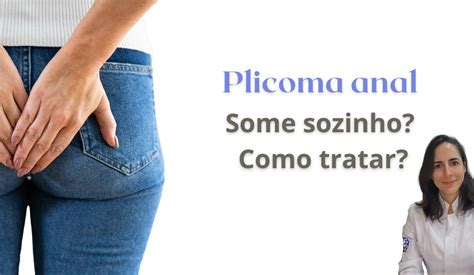 Plicoma Anal Some Sozinho Como Tratar Lorena Willers Proctologista