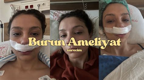 BURUN DEVİASYONU AMELİYAT SÜRECİM DEVLET Öncesi ve sonrası deviasyon