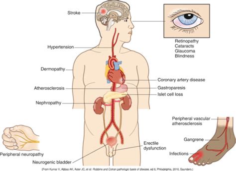 DM Acute And Long Term Complications Flashcards Quizlet