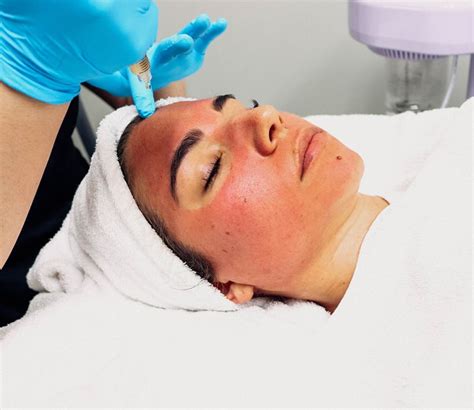 What Is A Vampire Facial Microneedling With Prp Artofit