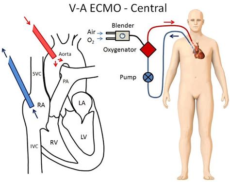 IcuECMO ECMO Configurations