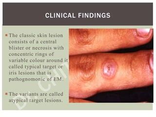Erythema Multiforme Dr Chithra P PPT