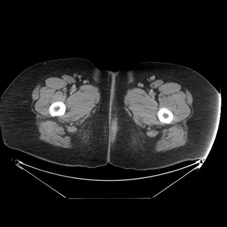 Bartholin Gland Cyst Radiology Reference Article Radiopaedia Org