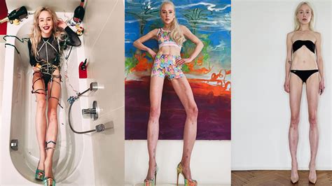 Nach Beinverlängerung Schock Diagnose für GNTM Model Fischer stars24