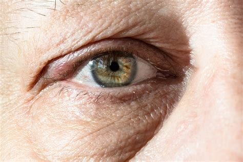 Nashville Chalazion Symptoms Causes Treatment