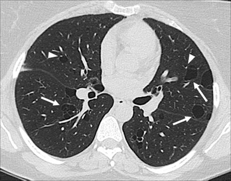 Imaging Of Cystic Lung Disease Radiologic Clinics
