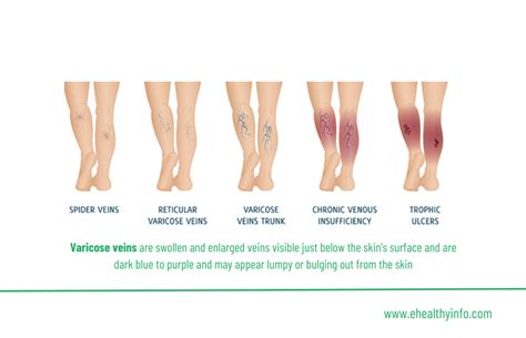 Varicose Veins Treatment Varicose Veins Venous Ulcers Venous Stasis