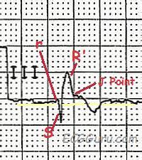 Inferior Wall M I And Right Bundle Branch Block Ecg Guru