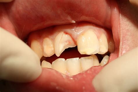 Fracturas Dentales Qu Hacer Ante Una Fractura Dental Urgencias The