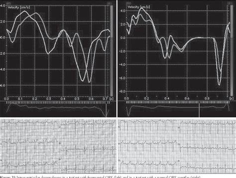 figure 3 from the utility of fragmented qrs complexes to predict significant intraventricular
