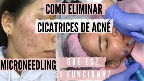 COMO ELIMINAR CICATRICES DE ACNE QUE ES MICRONEEDLING CITA 1 YouTube