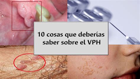10 Cosas Para Saber Sobre El VPH YouTube