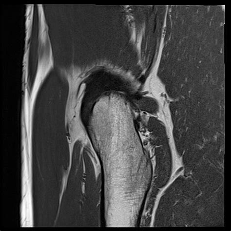 Normal Hip MRI Sagittal View 2 Diagram Quizlet