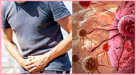 Prostate Cancer Early Warning Signs