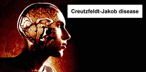 Penyakit Creutzfeldt Jakob Dewan Medis