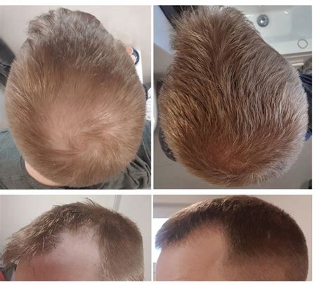 Finasteride Results Timeline Photos Before After