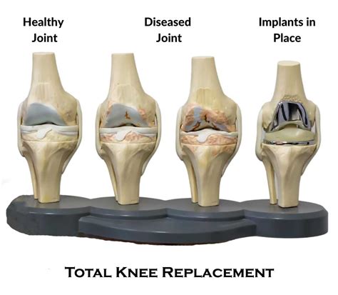 Doctor S Advice Knee Replacement Quill Orthopaedic Specialist Centre