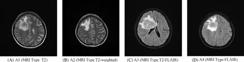 Ground Truth Magnetic Resonance Imaging Mri Images From The Brats