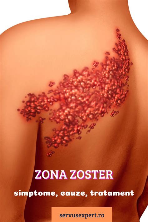 ZONA ZOSTER Simptome Cauze Tratament Gesundheit Und Wellness