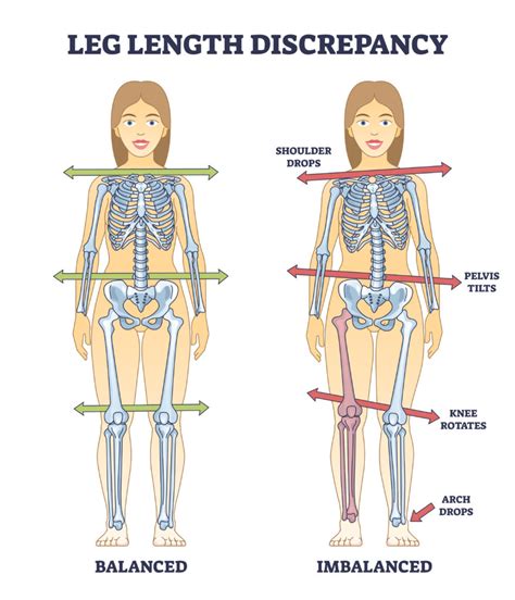 Understanding And Treating Leg Length Discrepancy Utah Sports And