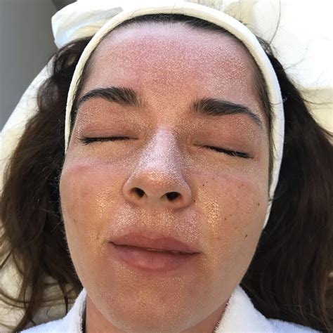 Laserowe usuwanie blizn potrądzikowych Ars Estetica