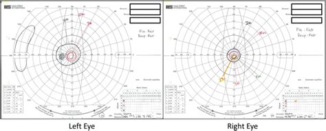 The Visual Fields Of Patient The Goldmann Visual Fields Testing At