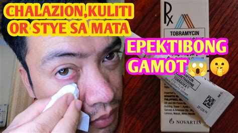 MABISANG GAMOT SA CHALAZION KULITI STYE NG MATA IISA LANG GINAMIT KO