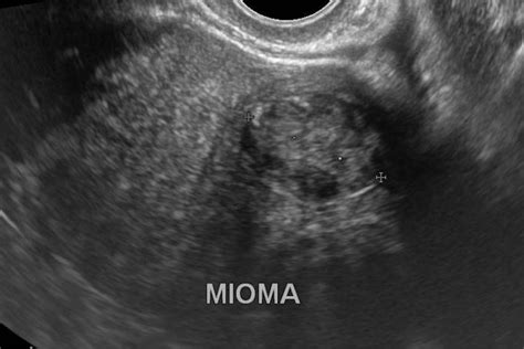 Diagnóstico ecográfico de mioma uterino en mujeres con síntomas