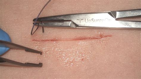 Simple Interrupted Suture Upsurgeon