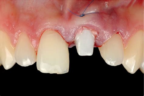 Figure 21 From Predictable Immediate Implant Placement And Restoration