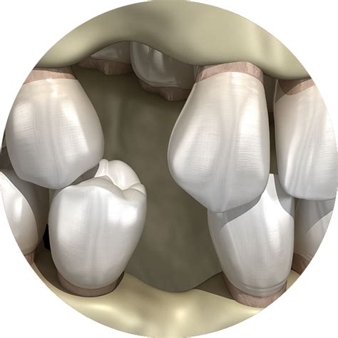 Bone Loss Louisville Ky Bone Grafting Advanced Implant Centers