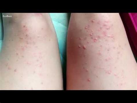 Cómo quitar los granitos de las piernas de forma natural YouTube