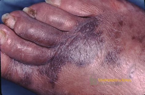 Maroon Plaque On The Dorsal Foot And Toes Click Images For Higher