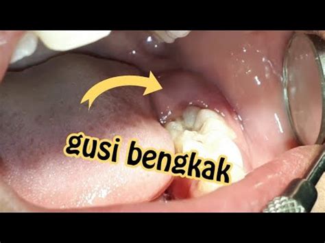Cara Mengatasi Sakit Gusi Bengkak Homecare24