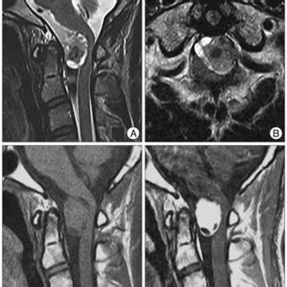 Preoperative Sagittal A And Axial B T2 Weighted Magnetic Resonance