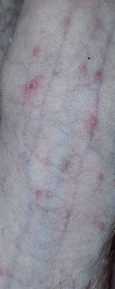 Alguien Me Puede Decir Que Tengo Puntos Rojos En Pene