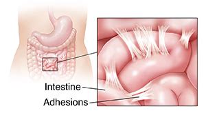 Understanding Lysis Of Adhesions Saint Luke S Health System