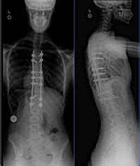 Minimally Invasive Scoliosis Surgery Texas Spine And Scoliosis
