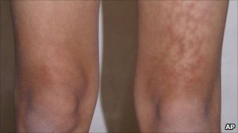 Rashes Between Thighs Due To Friction At Duane Eaton Blog
