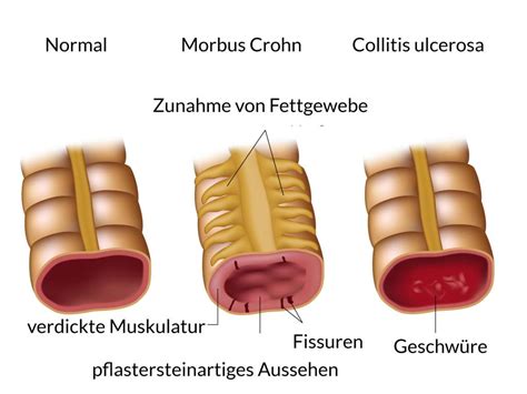 Colitis Ulcerosa Ursachen Symptome Behandlung