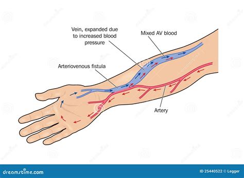 Dialysis Arteriovenous Fistula Vector Illustration CartoonDealer