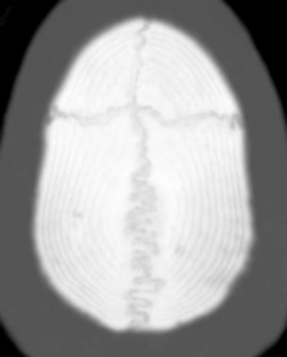 Persistent Metopic Suture Image Radiopaedia Org
