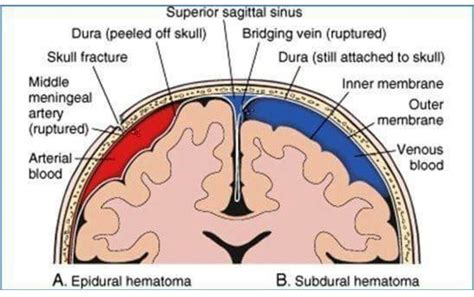 Epidural Vs Subdural Hematoma