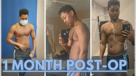 1 Month Post Op Top Surgery Double Incision FTM Dr Mosser Top