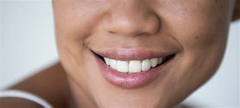 Lente de contato dental o que é e quanto tempo dura Minha Vida