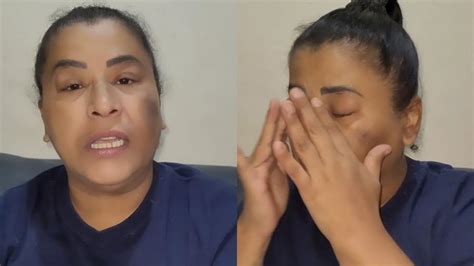 Funkeira amputa perna ganha prótese e pede ajuda aos fãs