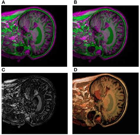 frontiers non rigid multi modal medical image registration based on improved maximum mutual