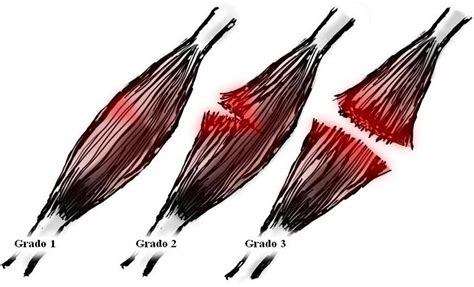 Desgarro muscular Tratamiento y recuperación Clínica Sohail