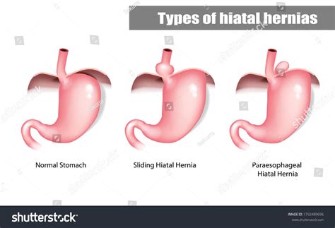 Types Of Hiatal Hernias Sliding And Paraesophageal Cartoon Vector The