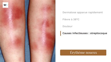 Érythème noueux diagnostic traitement